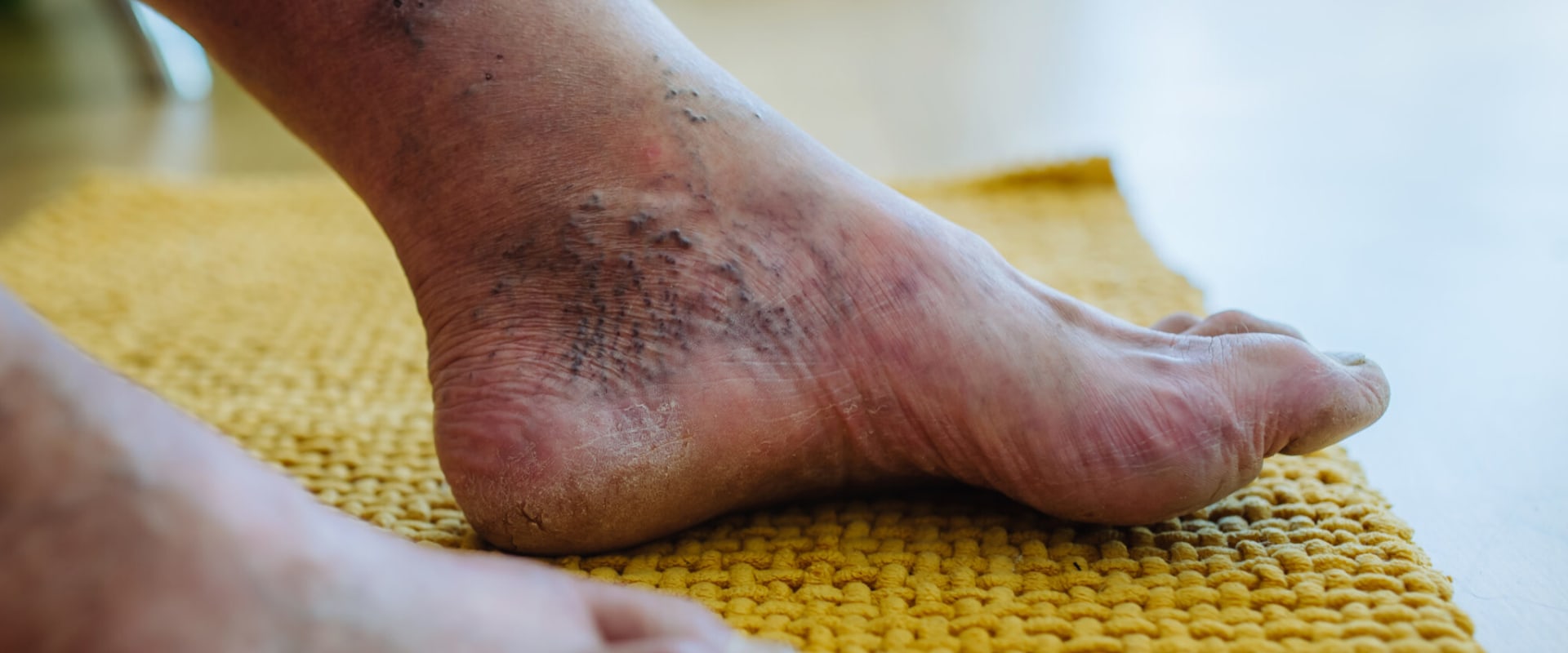 The Impact of Diabetes on the Feet: Understanding Diabetic Foot Problems