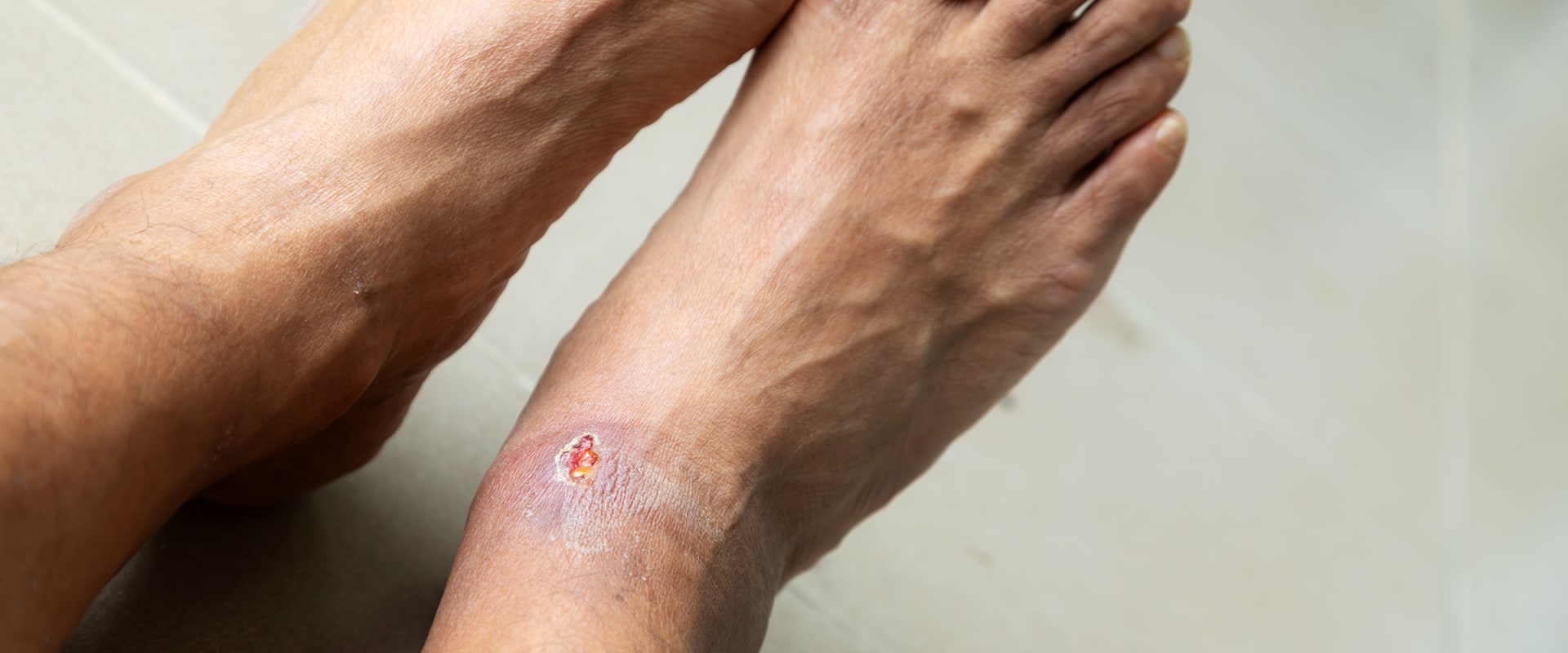 The Devastating Effects of Diabetic Foot Ulcers: Understanding the 5 ...