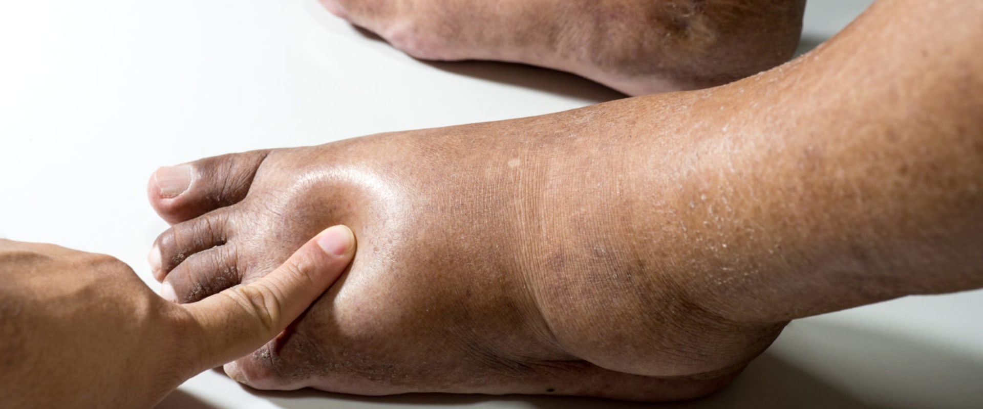 Diabetic-foot-problems